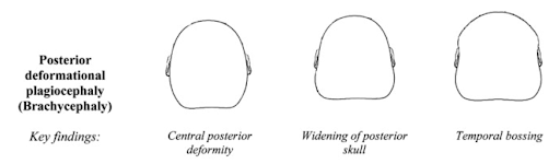What Parents Need to Know About Their Baby's Head Shape. - Canobolas ...